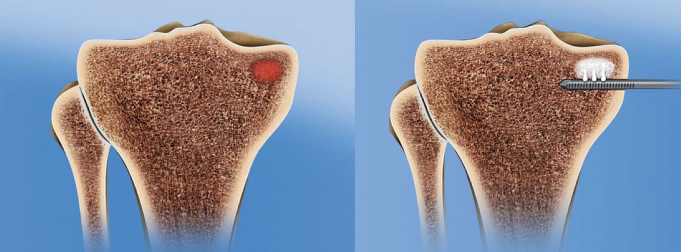 Cartilage Restoration & Subchondroplasty Malaysia - Orthopedic ...