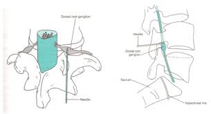 Dorsal Root Ganglion (DRG) Block Malaysia | Spine Pain Relief – Dr ...