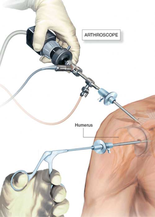 Shoulder Arthroscopy Malaysia | Minimally Invasive Shoulder Surgery ...